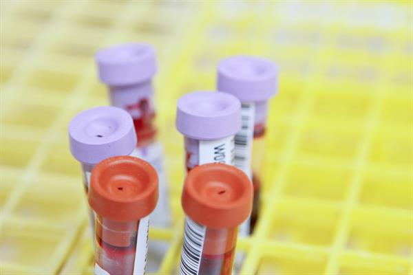 Blood test can detect more than 50 cancer types – Brain Tumour Research