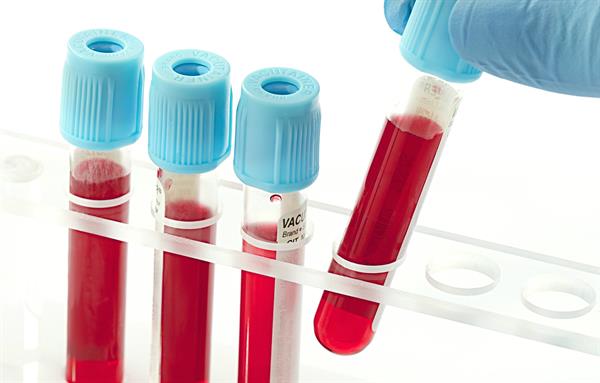 Blood test to detect brain metastases – Brain Tumour Research